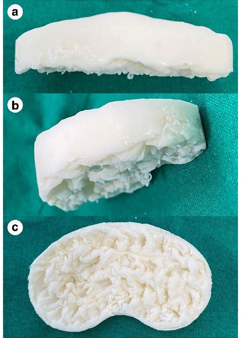 Intra Operative Photograph Of A Tibial Cement Spacer With Spikes A Download Scientific Diagram
