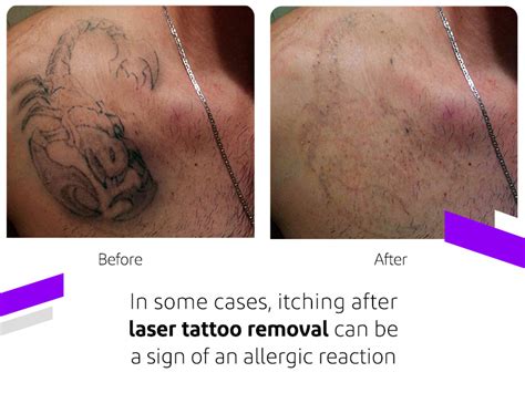Tattoo Has Bumps And Itches