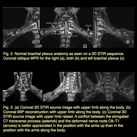 Brachial Plexus Mri Scan