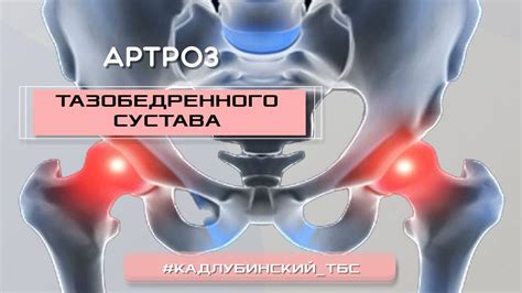 Артроз тазобедренного сустава Youtube
