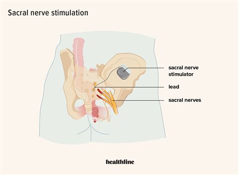 Sacral Nerve Stimulation For Overactive Bladder Benefits Risks