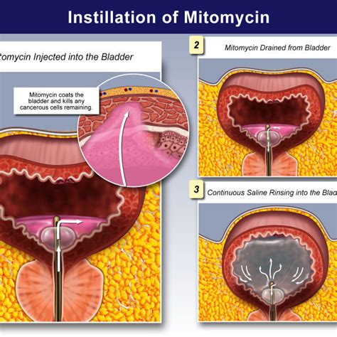 Delayed Bladder Perforation Trial Exhibits Inc