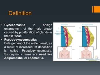 Gynecomastia Final Pptx