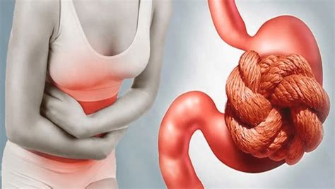 Chronic Idiopathic Constipation Cic Treatment Market To Witness