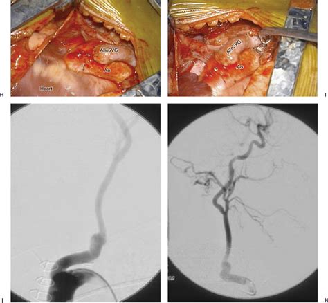 Extracranial Intracranial Bypass With Interposition Graft Neupsy Key