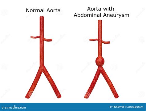 Aortic Abdominal Aneurysm 3d Medical Illustration Isolated On White