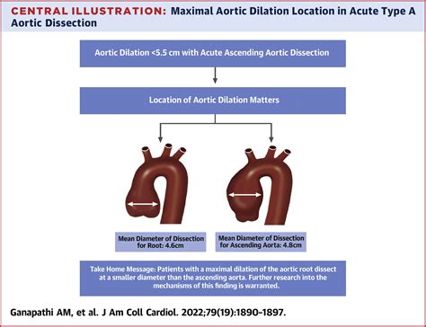 Location Of Aortic Enlargement And Risk Of Type A Dissection At Smaller