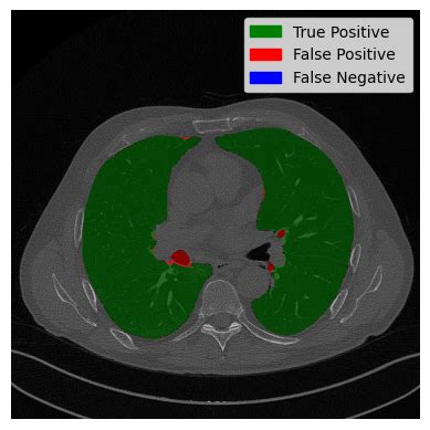 Lung Segmentation Frederik Hartmann