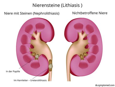 Nierensteine Symptome