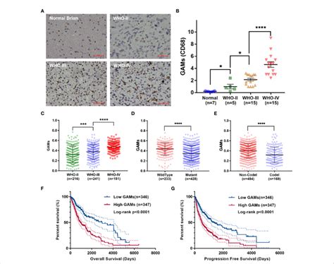 analysis of correlation between the infiltration of gams and glioma