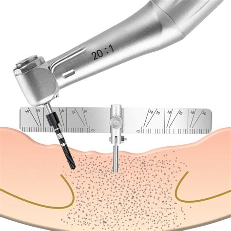 Dental Implant Locating Guide Rule
