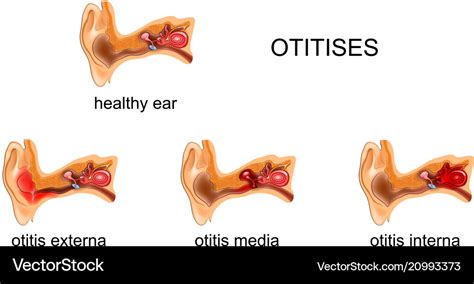 Ear Otitis Media Internal External Royalty Free Vector Image