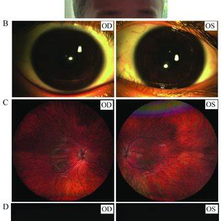 Representative Clinical Findings In Patients With Causative HPS6 Download Scientific Diagram