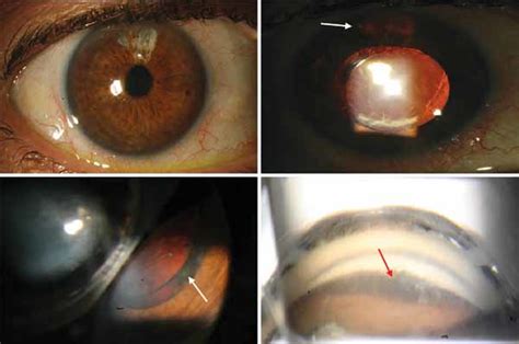 A To D Anterior Segment A And B A Marked Iris Atrophy Superior Download Scientific