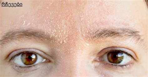 ატენიანეთ მშრალი კანი საუკეთესო სახლის საშუალებებით