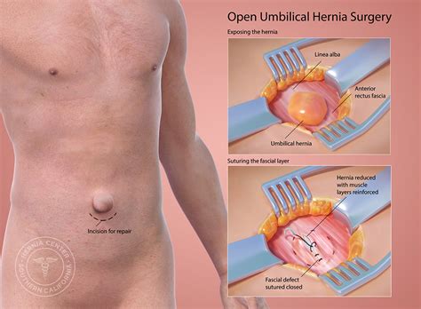 Herniated Belly Button Surgery