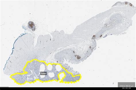 tumor margin annotation image analysis image sc forum
