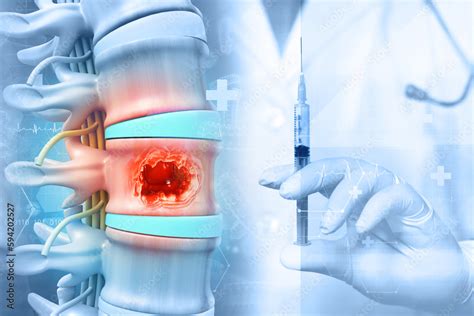 Lumbar Spine Injection Backbone Or Spinal Column Treatment With Epidural Injection Spine