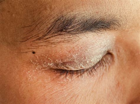 Dry Eyelids Causes