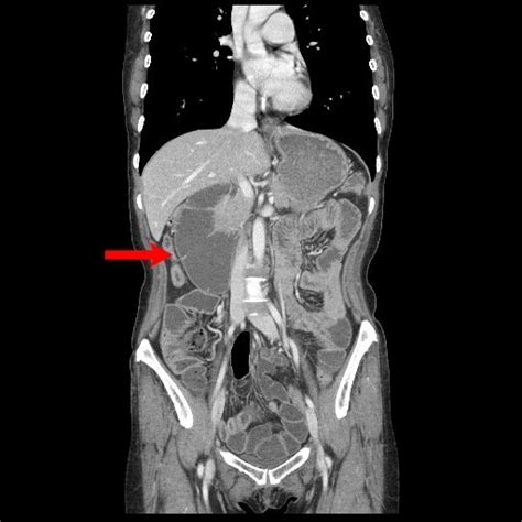 Duodenojejunostomy Bypass Cpt