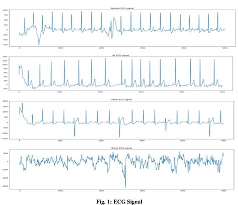 Figure 1 From Atrial Fibrillation Detection Through Ml Approach A