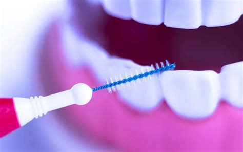 Cepillos Interproximales En Ortodoncia La Clave Para Una Higiene