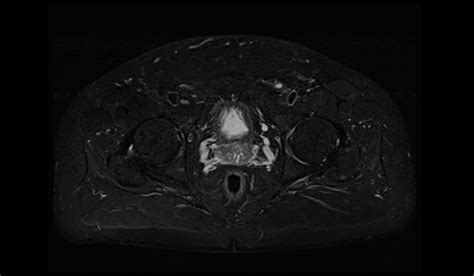 Mri Fat Saturation Mri Fat Suppression Techniques