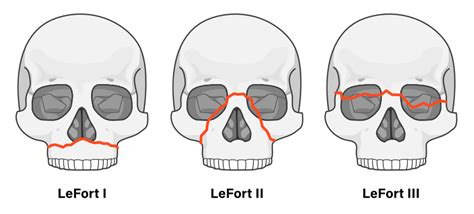 Le Fort Fracture The Association Of Le Fort Midfacial Fractures With