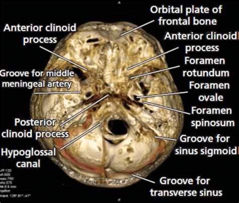 Complications Of Percutaneous Trigeminal Ganglion Procedures Anesthesia Key