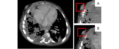 Subcutaneous Nodular Lesion A Mediastinal Window Without Contrast Download Scientific Diagram