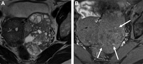 Sex Cord Stromal Tumors Of The Ovary Radiologic Clinics