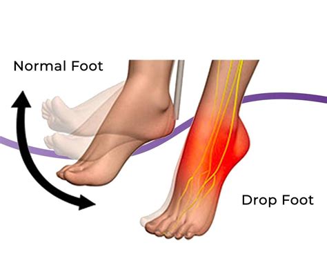 Mengenal Alat Bantu Jalan Ankle Foot Orthosis Untuk Penderita Penyakit Gangguan Otot Dan Saraf