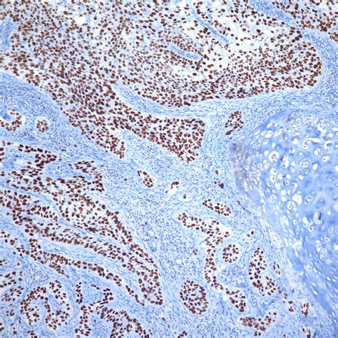 P63 | Pathology Resident Wiki | Fandom