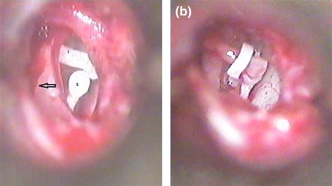 Ossicular Reconstruction Cure 2 World