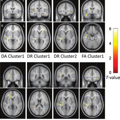 Voxel Based Analysis Results The Da Dr And Md Were Significantly