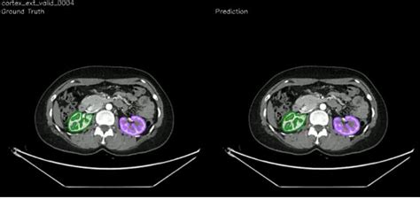 Measurement Of Renal Cortical Volume Using Ai And Prediction Of Renal Sportschosun