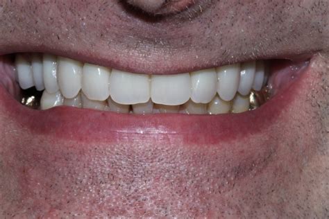 Excel Dental Straight White Healthy Teeth