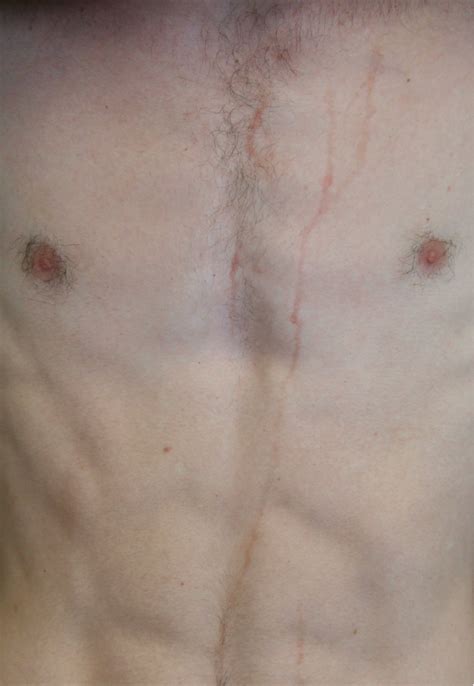 Phytophotodermatitis Consultant360