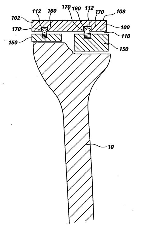 Tibial Augment Connector Eureka Patsnap