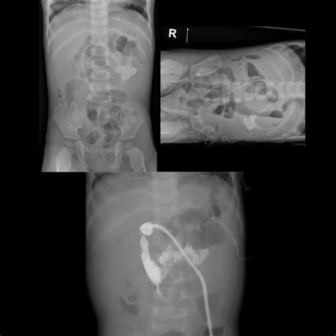 Pediatric Duodenal Perforation Pediatric Radiology Reference Article Pediatric Imaging