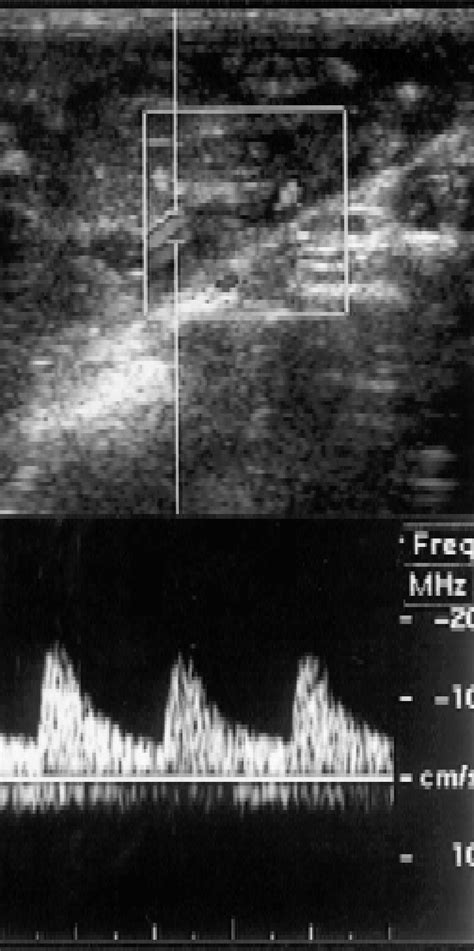 Normal Umbilical Artery Flow Velocity Waveform At 48 Days Gestation