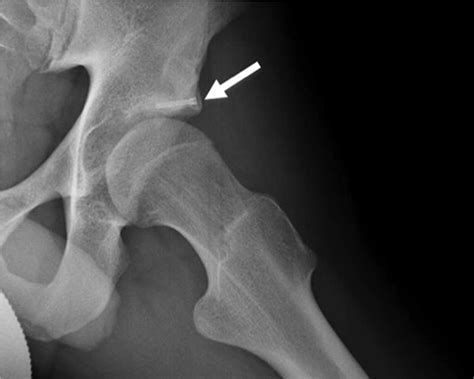 Screw Fixation Of Os Acetabuli An Arthroscopic Technique Arthroscopy