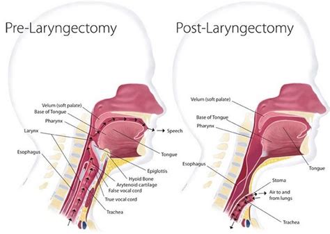 Laryngectomy Cost In United Arab Emirates Ent