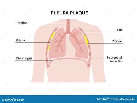 Pleural Plaque Poster Cartoon Vector 276464553