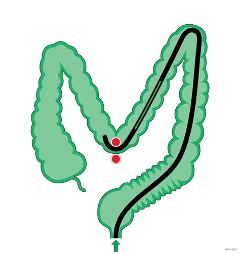 Overcoming The Transverse Colon Colon Explorer