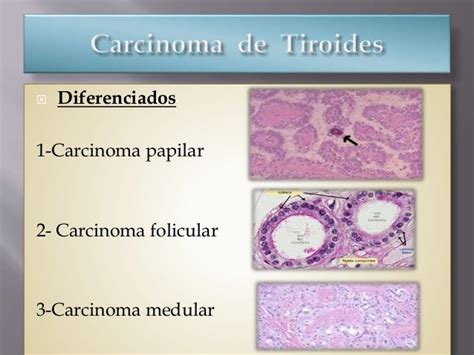 Tumores De Tiroides Ffdw