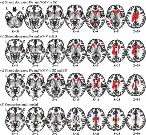 Multimodal Meta Analysis Of Alterations In Schizophrenia And Bipolar Download Scientific