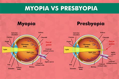 Presbyopia Vs Myopia Whats The Difference Between Both