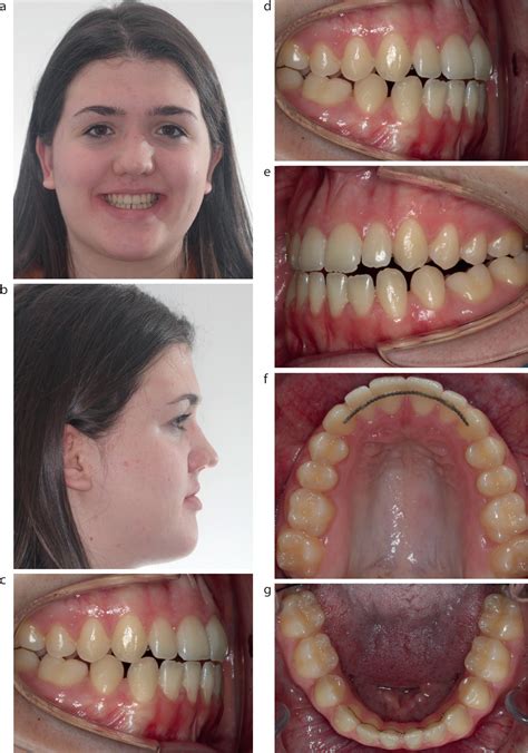 Orthodontic Update Root Resorption Why We All Need To Get Informed