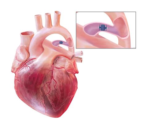 Patent Ductus Arteriosus Patent Ductus Arteriosus Kauvery Hospital